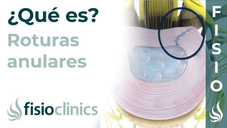 ֍ Roturas anulares o del anillo fibroso discal: ¿Qué es? ⚕️ Clínica ...