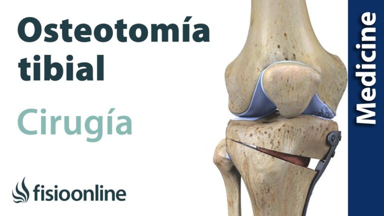 Cómo se lleva a cabo la osteotomía tibial? ⚕️ Clínica Estemedic