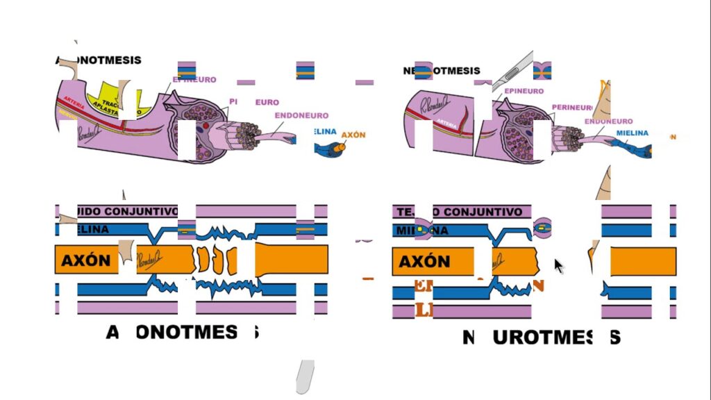 ֍ Lesión nerviosa neuropraxia ⚕️ Clínica Estemedic