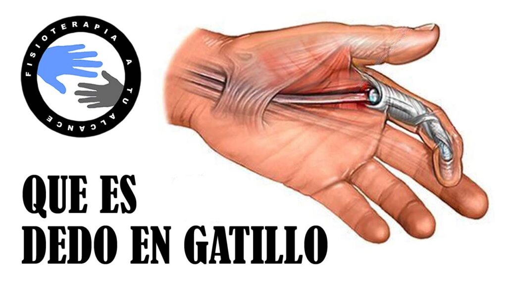 Tendré una fractura de falange distal del dedo pulgar? ¿Qué hacer para ...