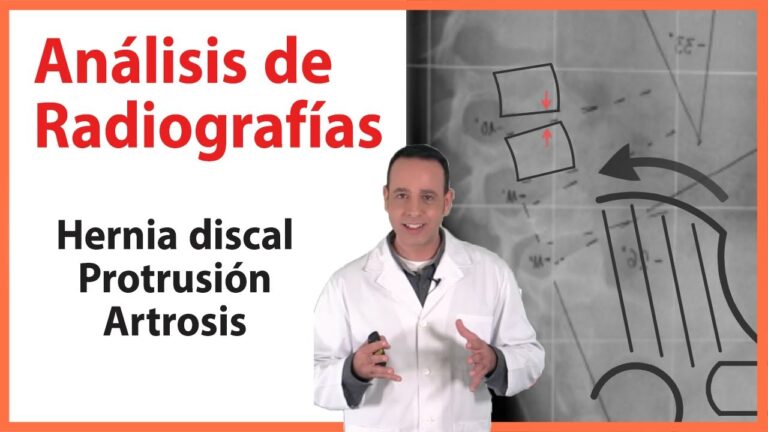 Qué es y cómo se diagnóstica la artrosis lumbar en una radiología? ⚕️ ...