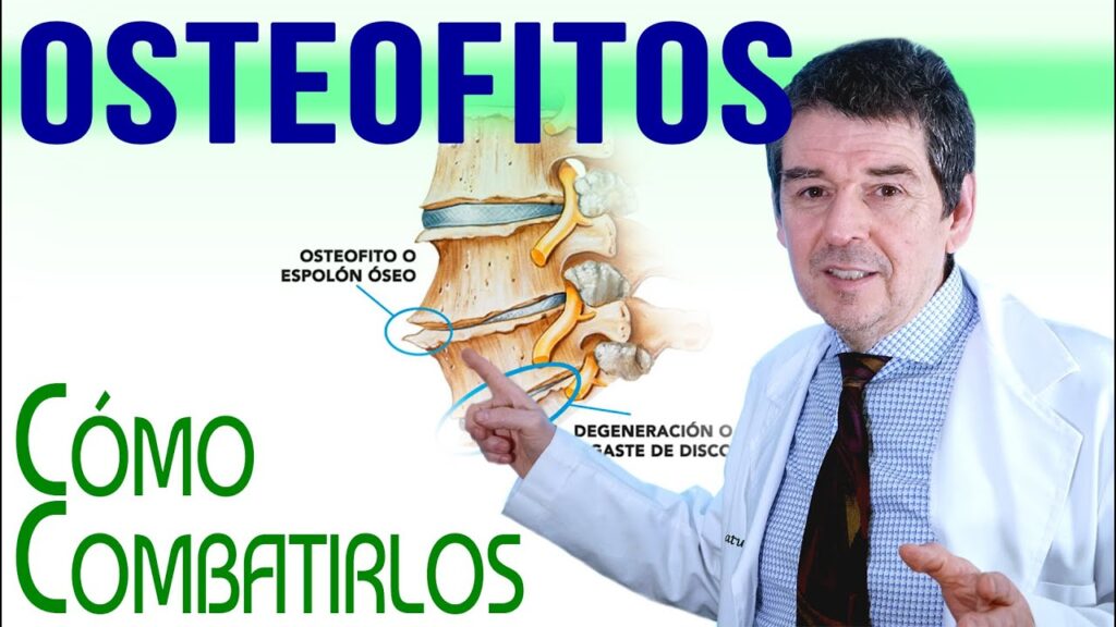 ֍ Tengo osteofitos en la rodilla ¿Qué debo hacer? ⚕️ Clínica Estemedic