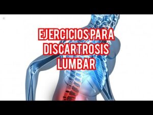 ֍ Tengo dolor lumbar por discartrosis ¿Qué tratamiento debo hacer? ⚕️ ...