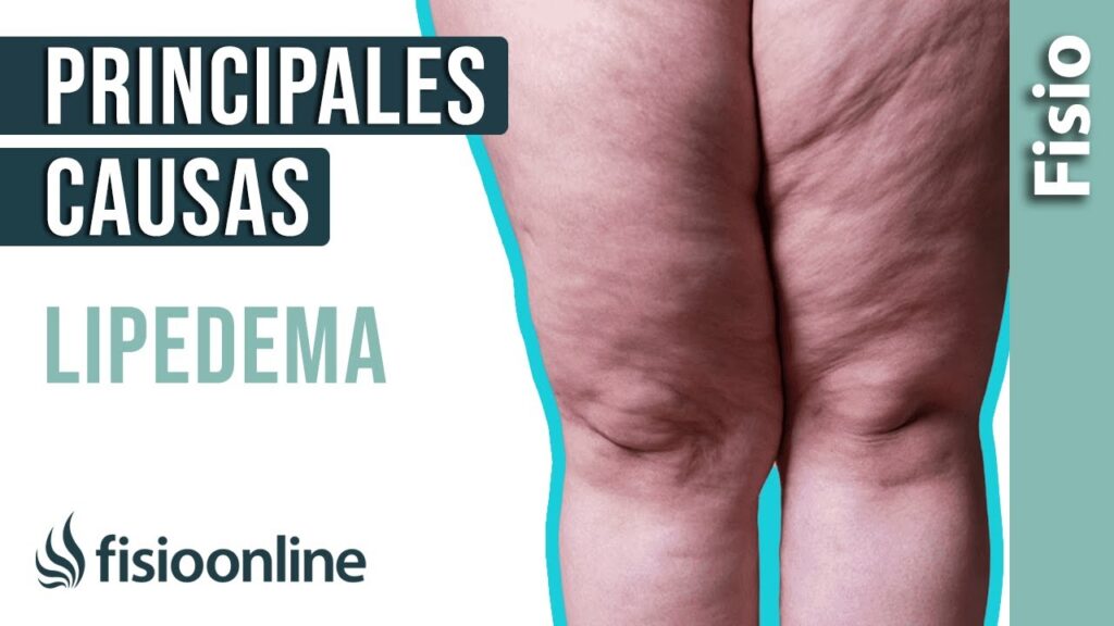 Qué es el lipedema y cuáles son sus causas? ⚕️ Clínica Estemedic