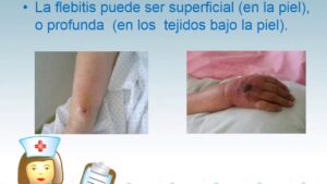 ֍ Flebitis: Qué es: tipos: síntomas y prevención ⚕️ Clínica Estemedic