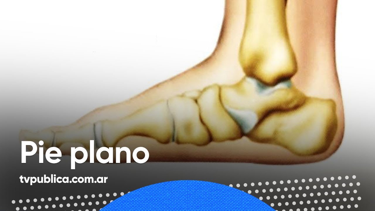 A partir de qué edad se puede diagnosticar o tratar el pie valgo? ⚕️ ...