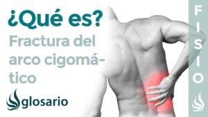 ֍ Fractura del arco cigomático ⚕️ Clínica Estemedic