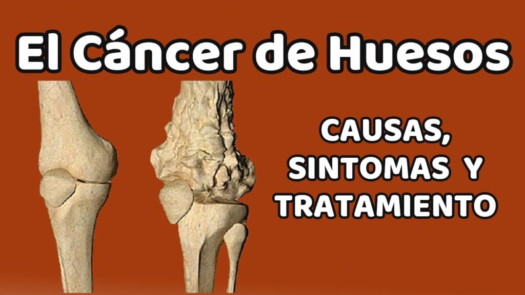 La radioterapia para tratamiento de cancer puede causar osteopenia u ...