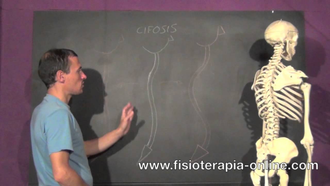 ֍ Cifosis: hipercifosis dorsal: dorso plano: ¿Qué es? ⚕️ Clínica Estemedic